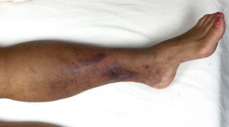 Complex Vein Problems - Asheville Vein Center