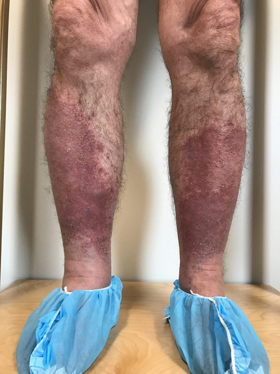 Complex Vein Problems - Asheville Vein Center